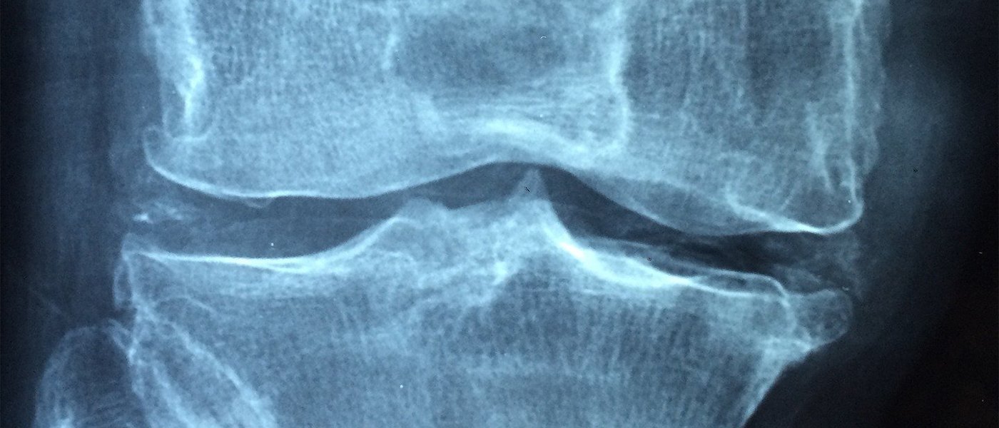 tendinite symptome : quels sont les symptômes de la tendinite