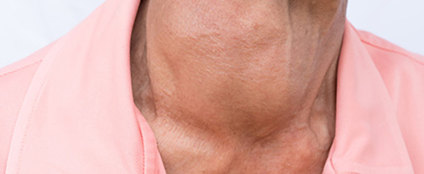 angine maladie : Quelles sont les causes de l'angine